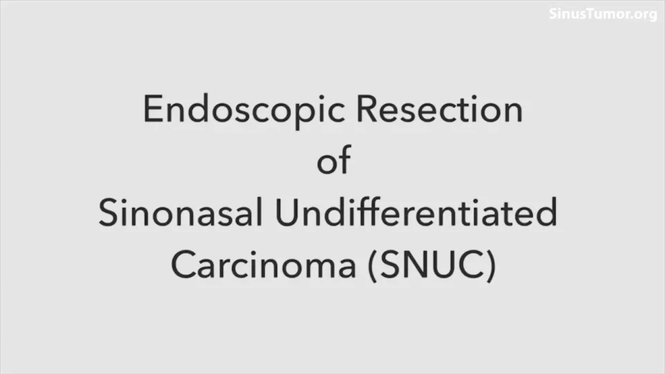 Sinonasal Undifferentiated Carcinoma