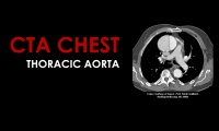 CTA Chest (Aorta) | Video Lesson | Clover Learning